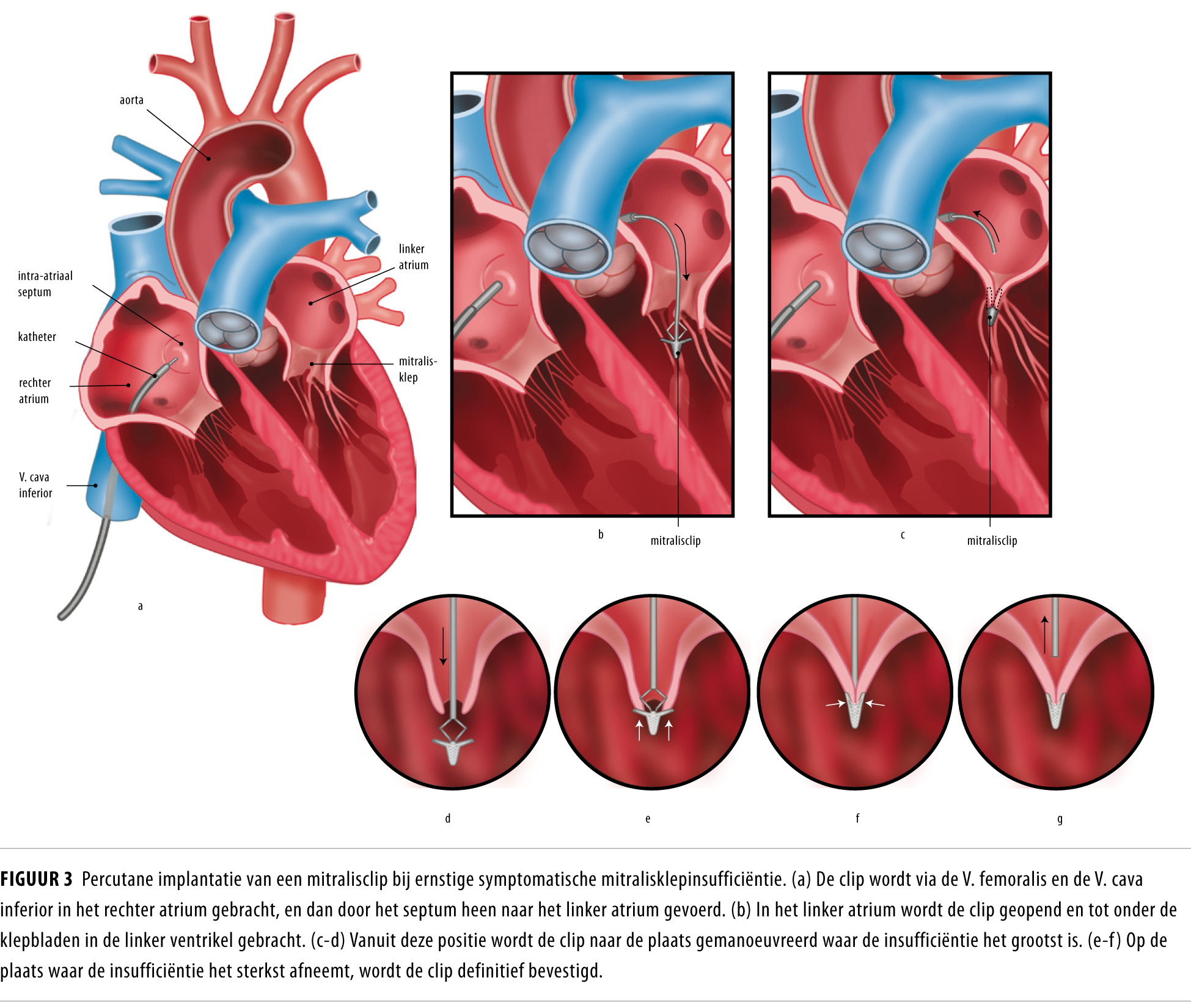 Mitralisklepinsufficiëntie: het lek te lijf | Nederlands Tijdschrift ...
