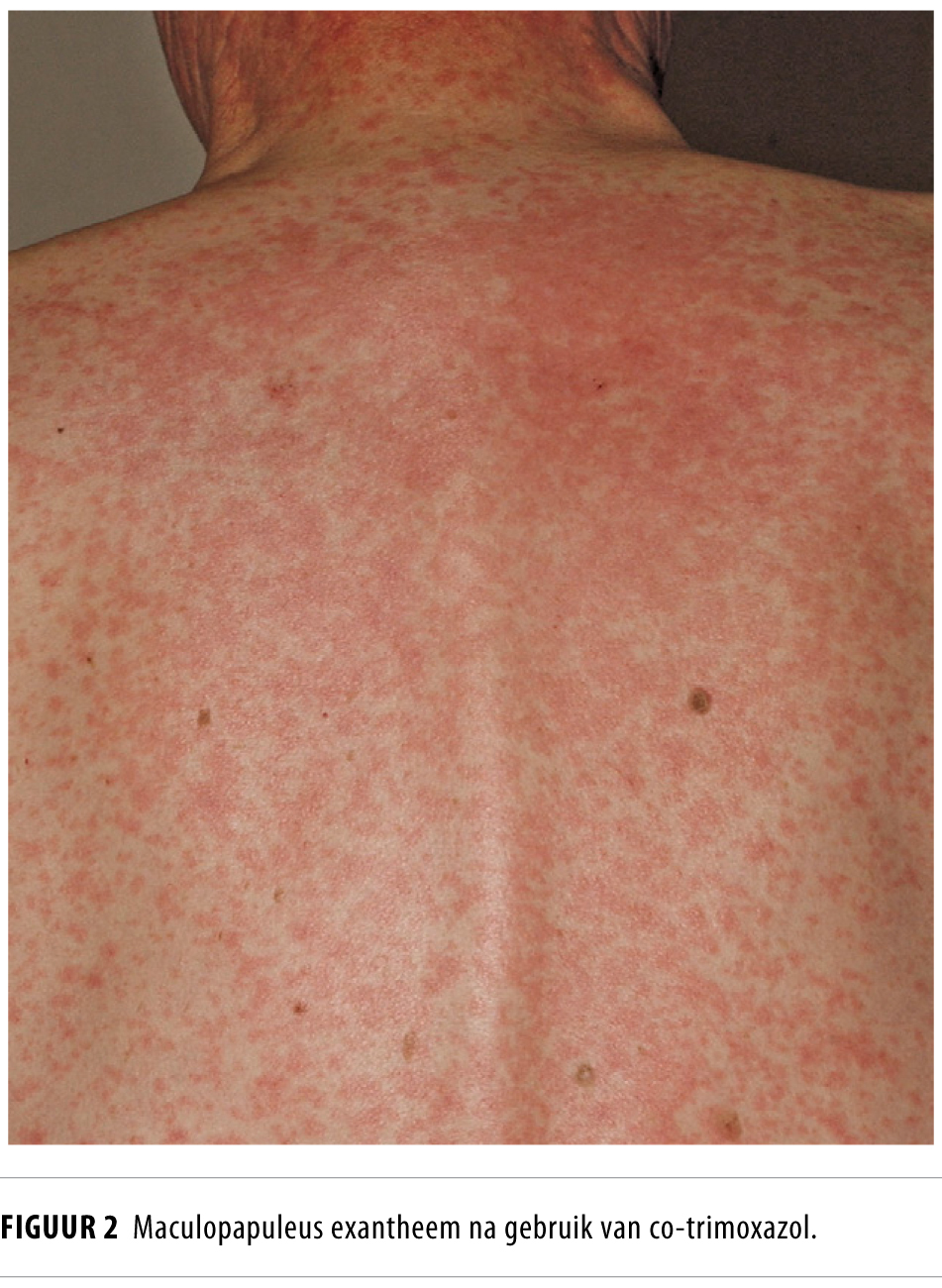 Huidreacties als bijwerking van geneesmiddelen | Nederlands Tijdschrift ...
