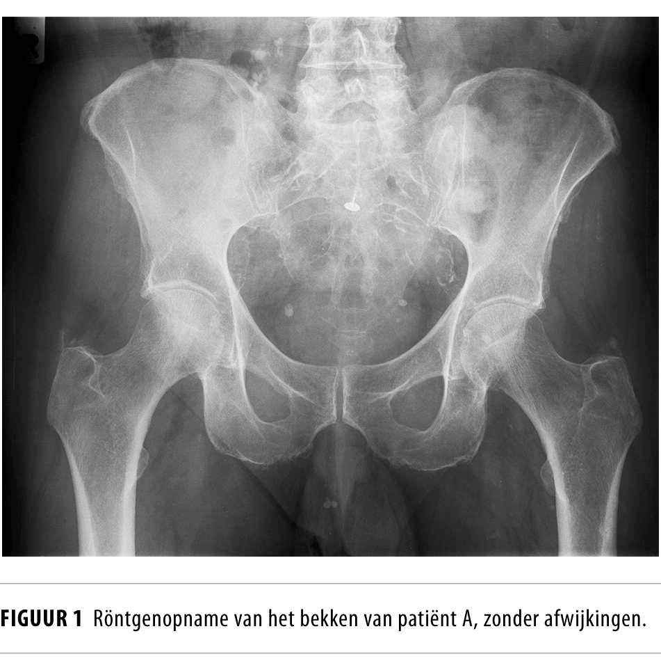 Ossale metastase of toch een insufficiëntiefractuur? | Nederlands Tijdschrift voor Geneeskunde