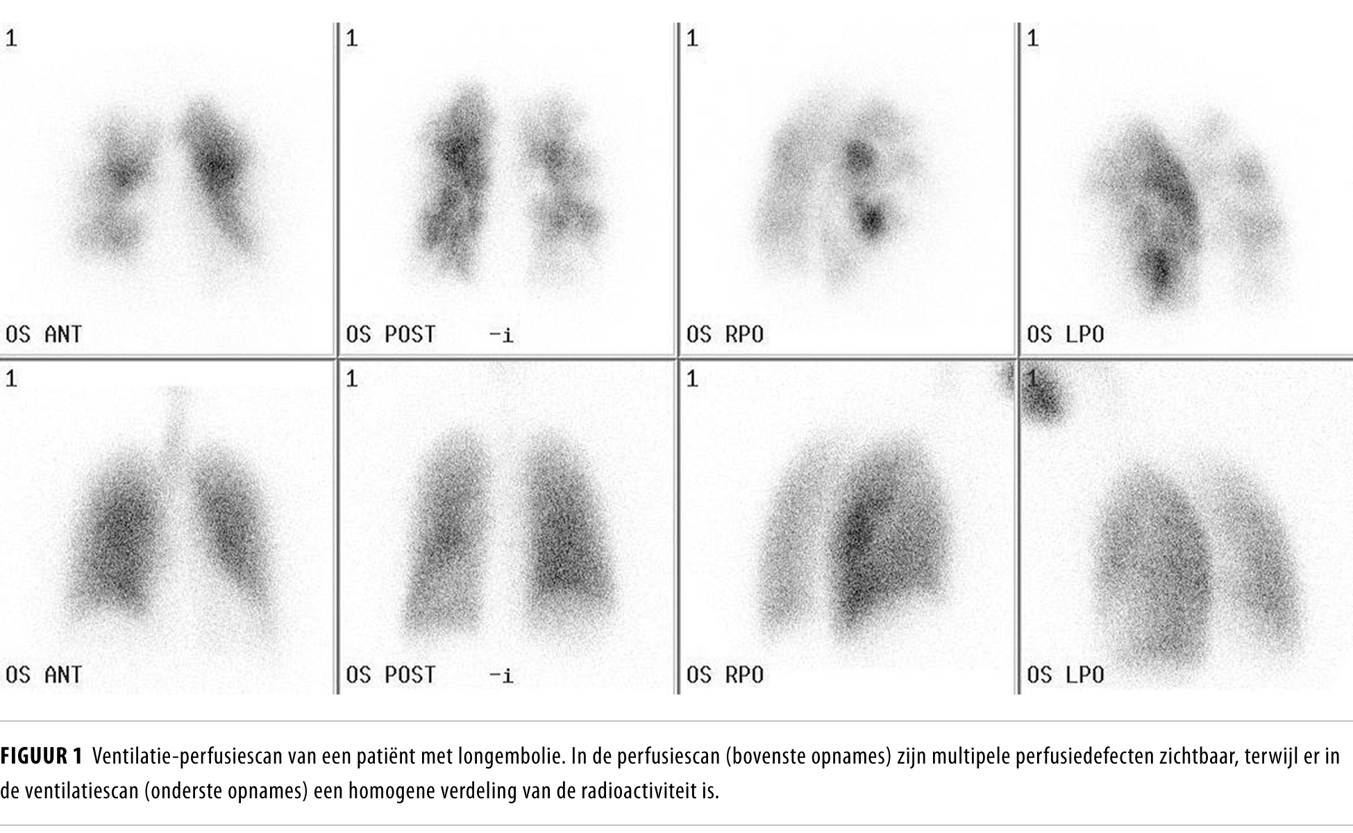 Beeldvormende technieken bij diagnostiek van diepe veneuze trombose en ...