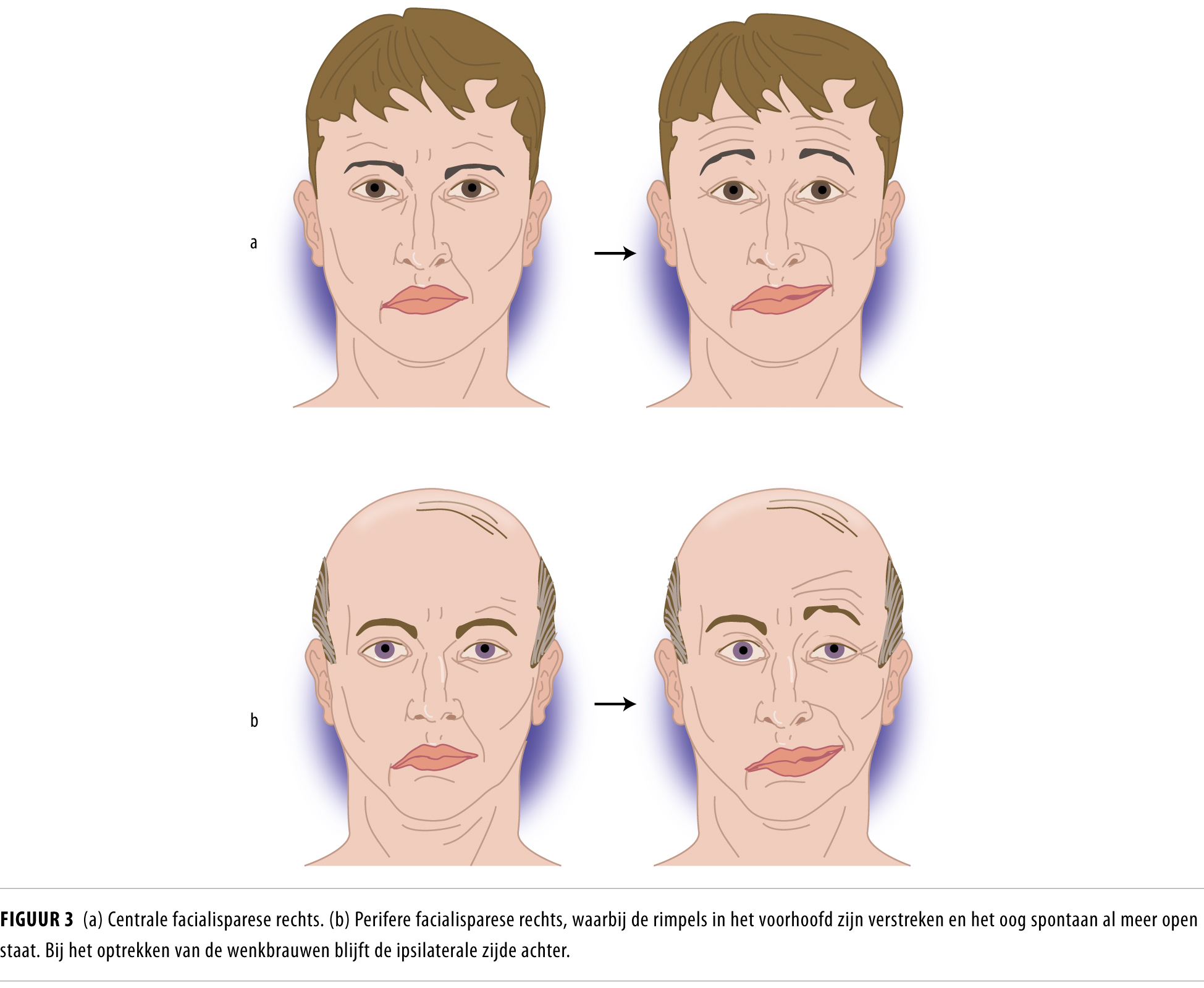 Parese , Parese erklärt » Definition & Heilbarkeit – KZBXA