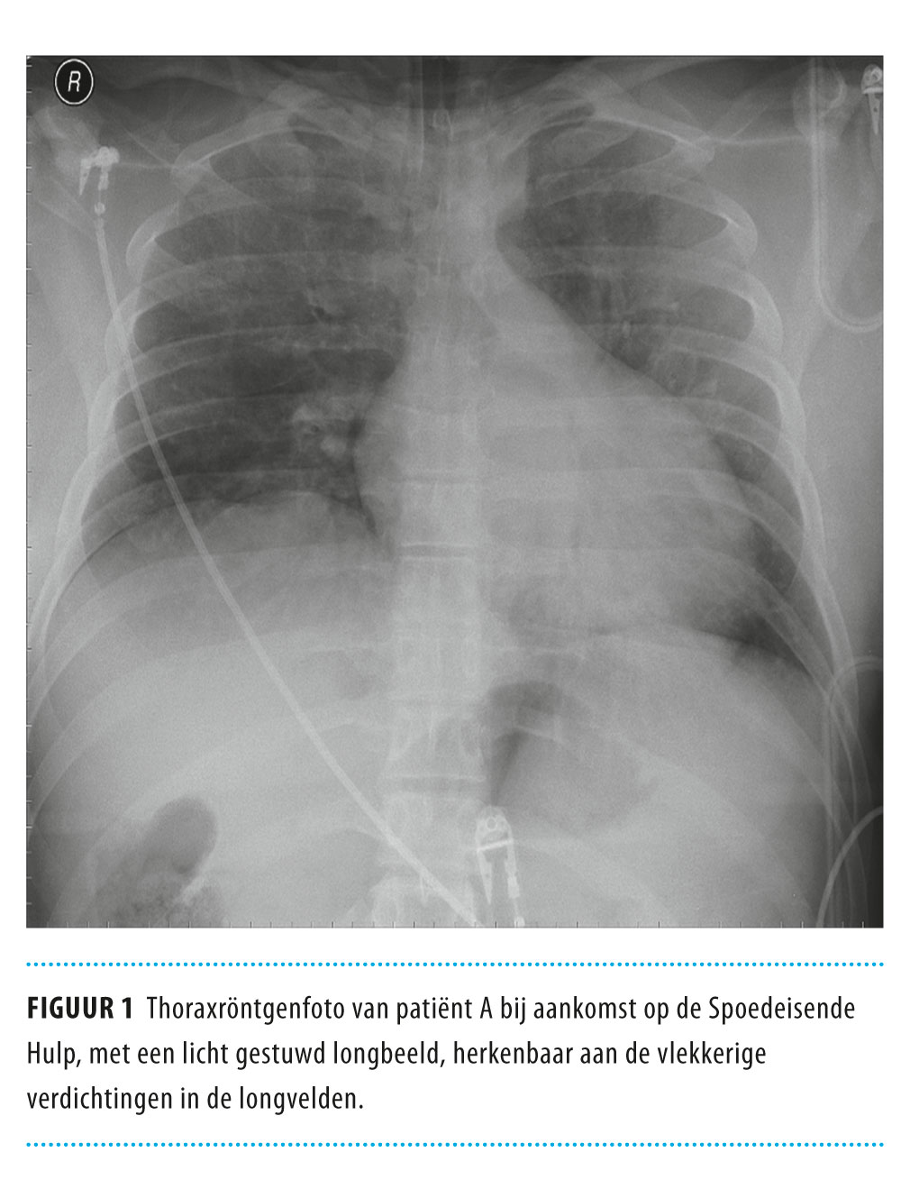 Longoedeem na een tentamen suicidii: postobstructief longoedeem ...