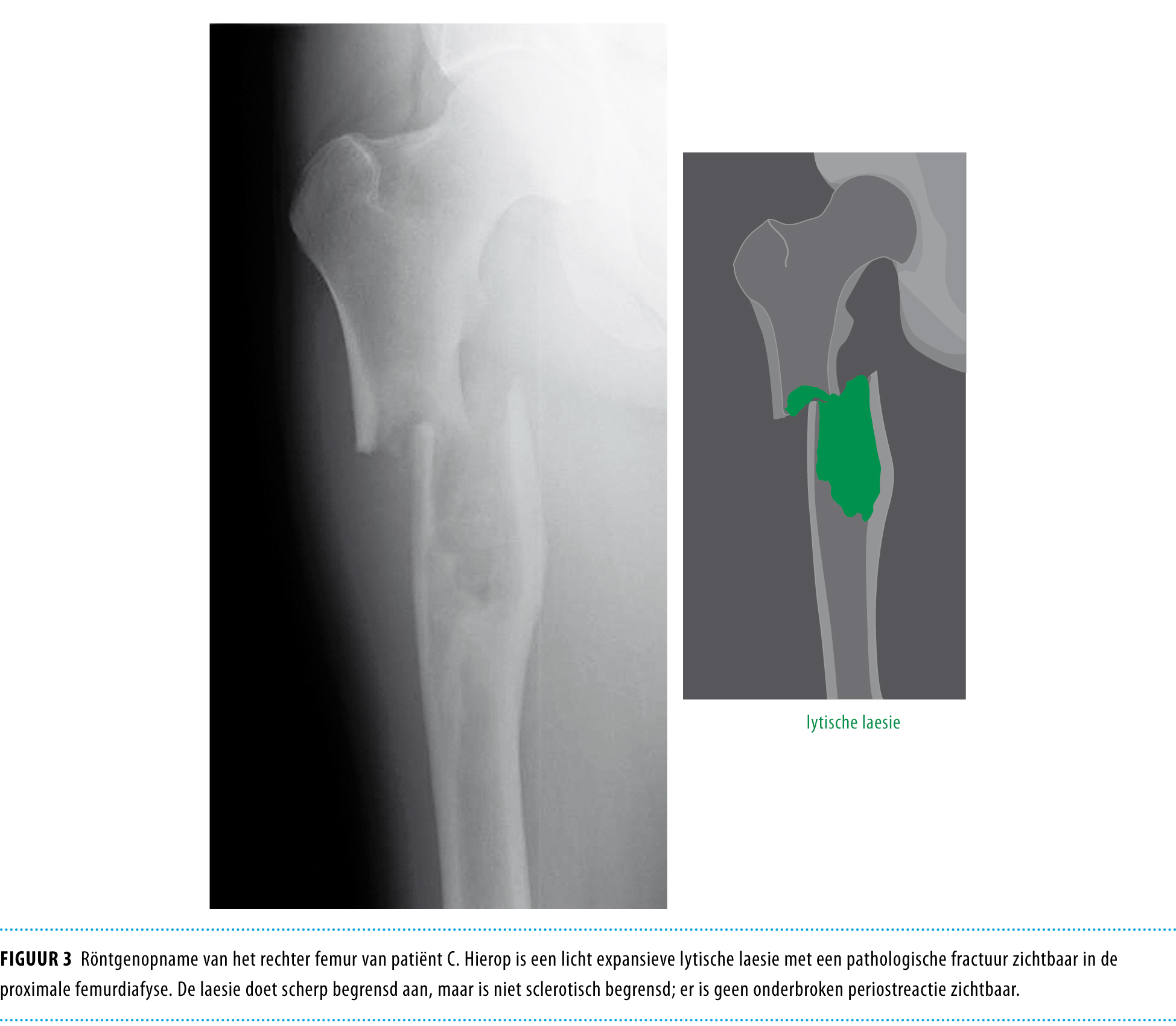 Een pathologische proximale femurfractuur: denk ook aan een primaire ...