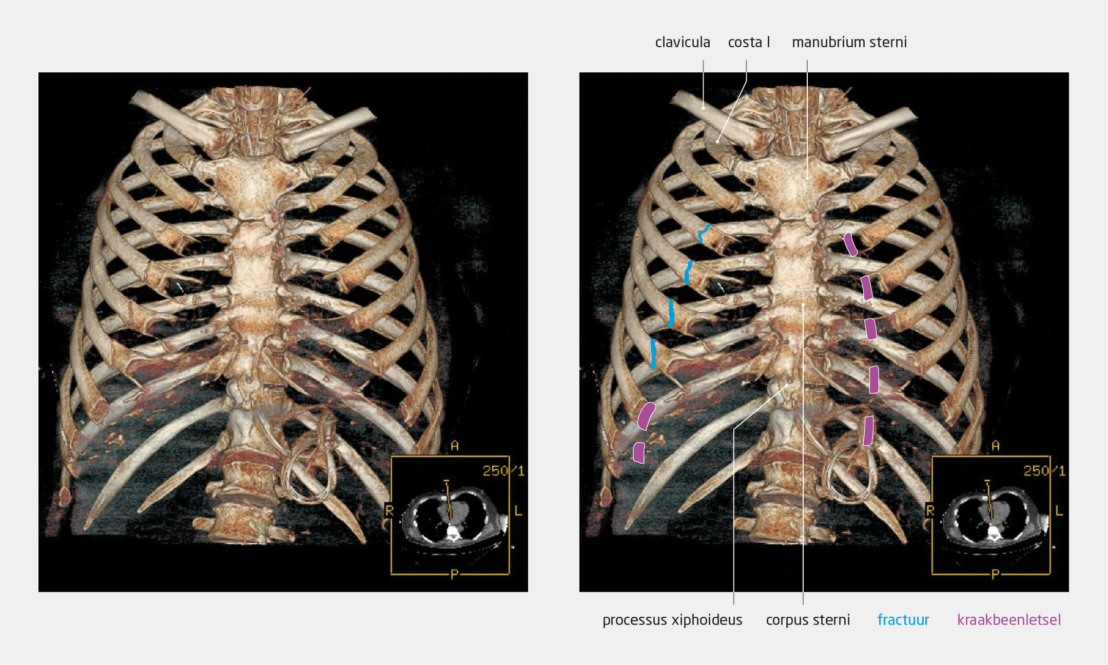 Fremre Hjerteanatomi Osteotomie Ter Hoogte Van De Knie Voor Jonge