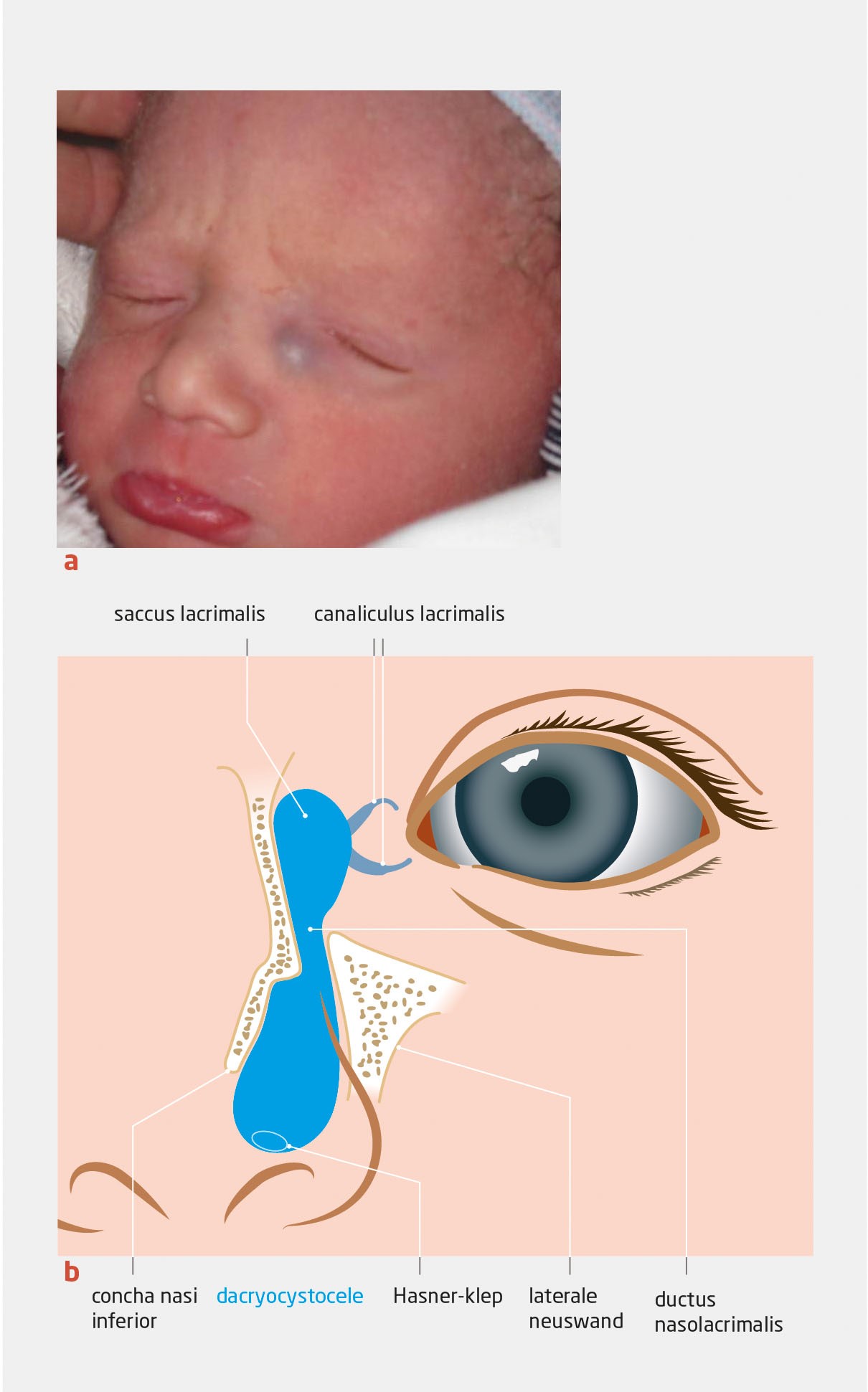 Neus Cellulitis Huidverjonging Gelaat Voor En Na Foto DermaPuur
