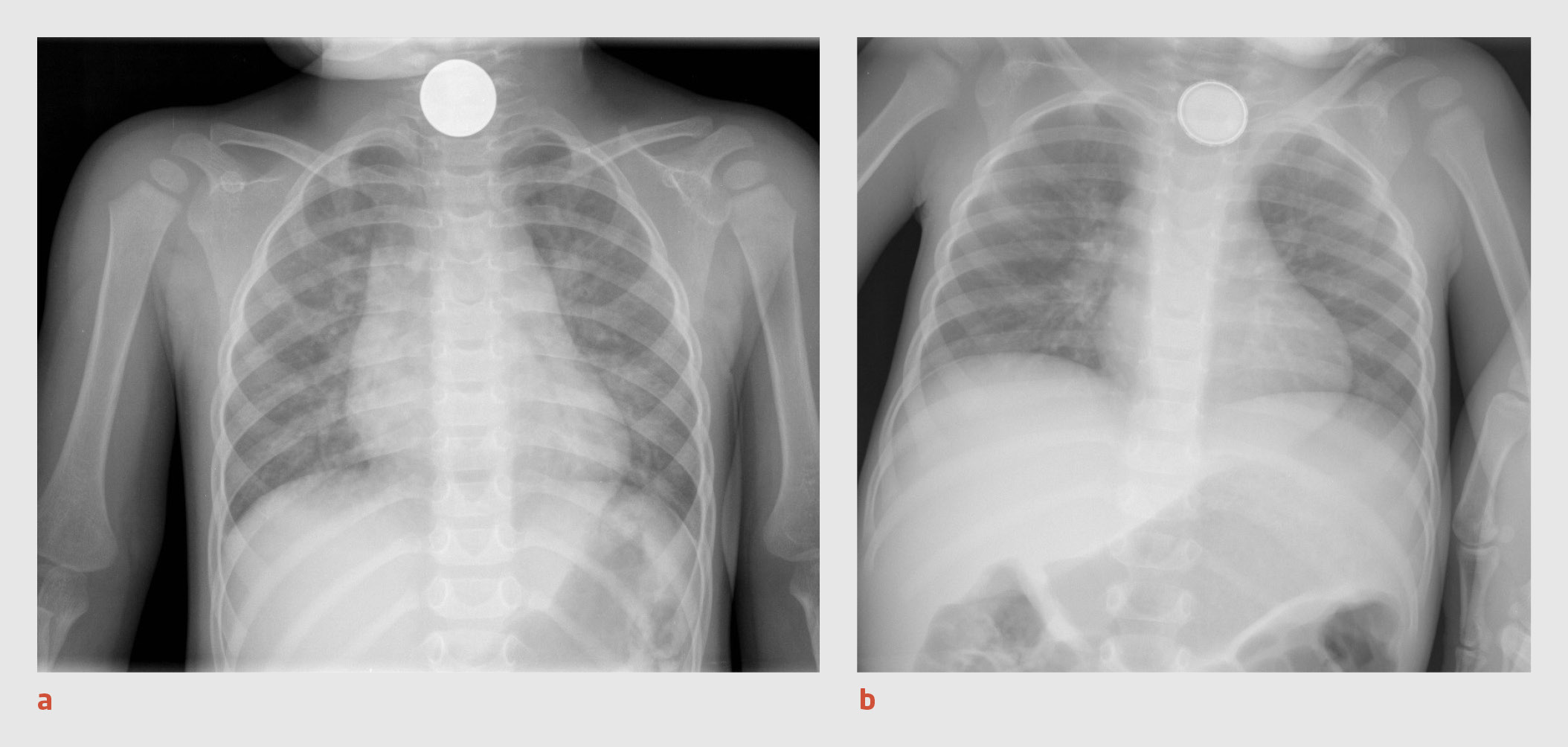 Richtlijn ‘Ingestie van corpora aliena bij kinderen van 0-18 jaar’ | NTVG