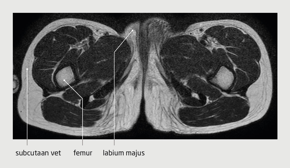 Zwelling van een labium majus bij een 6-jarig meisje | NTvG