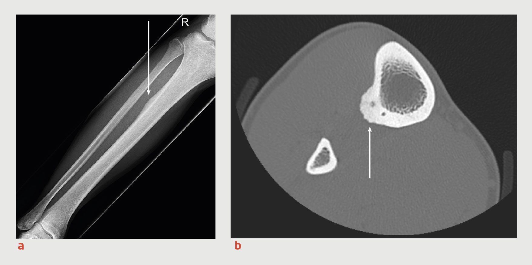 Een jonge man met nachtelijke pijn in een scheenbeen | NTvG