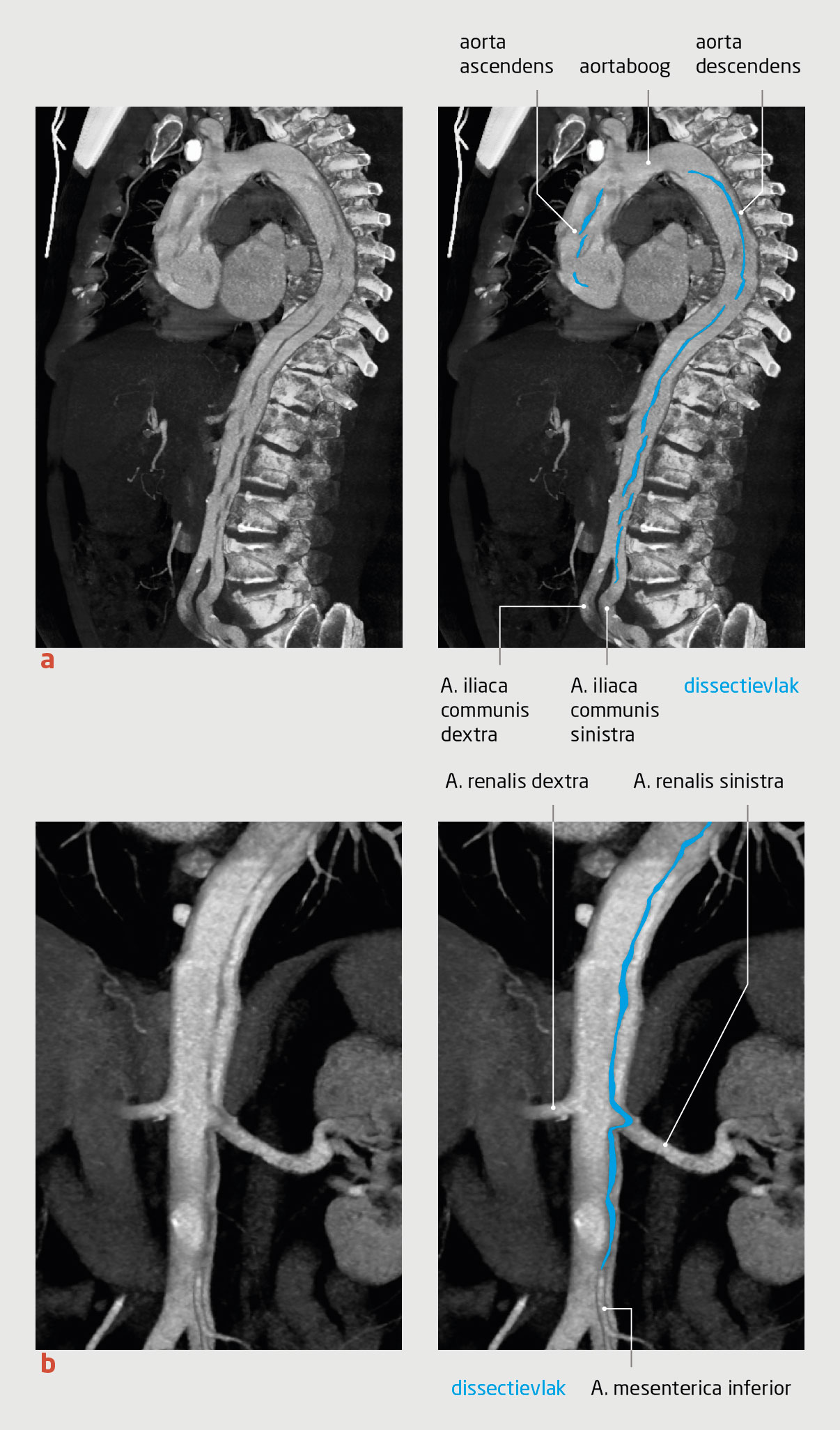 Acute dissectie van de thoraco-abdominale aorta | NTVG