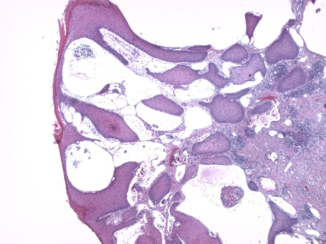 Het vulvaire lymfangioom | NTVG