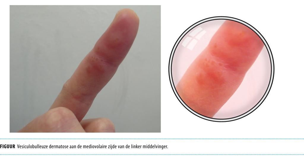 Een man met een pijnlijke vinger | NTvG