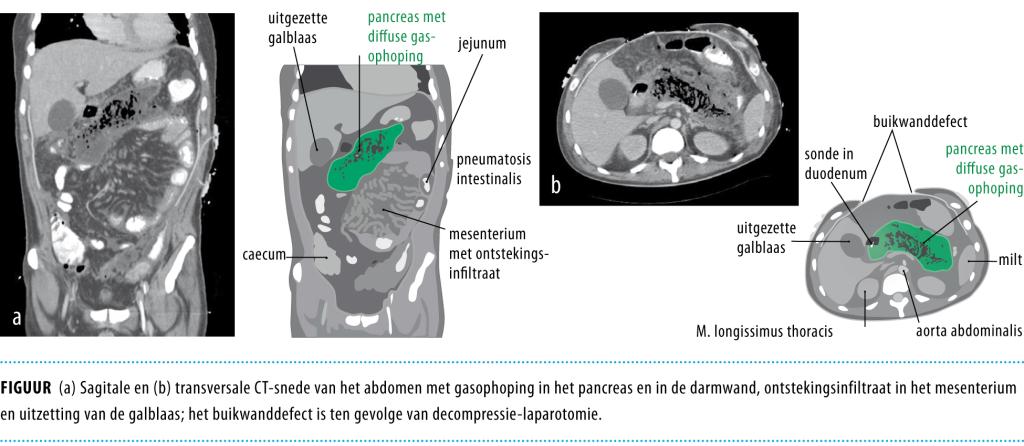 Een man met een ongewone abdominale gasophoping | NTvG