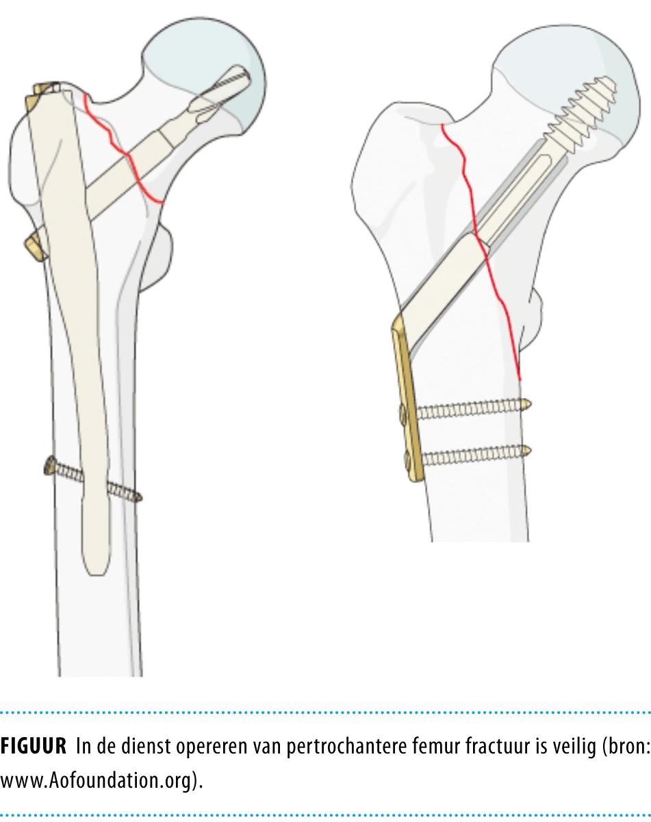 Pertrochantaire femurfracturen opereren in de diensturen is veilig | NTvG