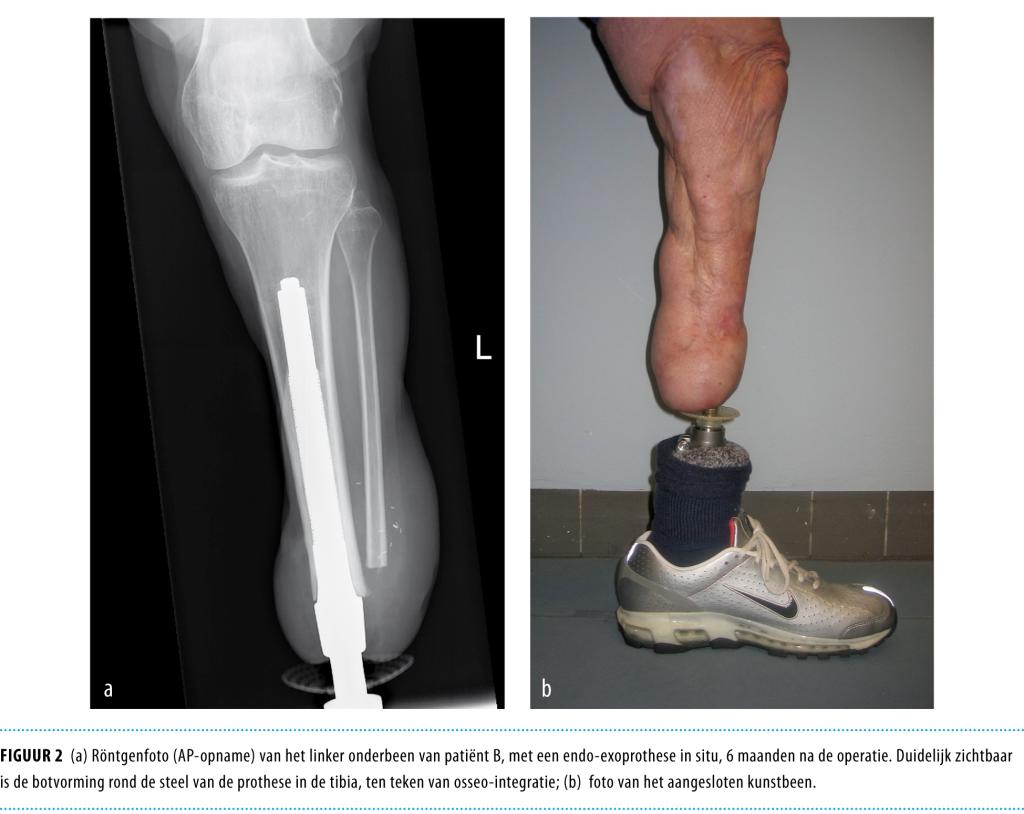 Klikprothese (endo-exoprothese) voor patiënten met een problematische ...