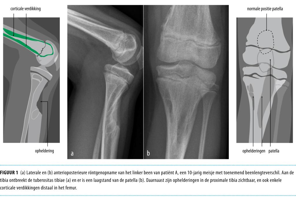 Progressief beenlengteverschil door multipele enchondromatose | NTVG