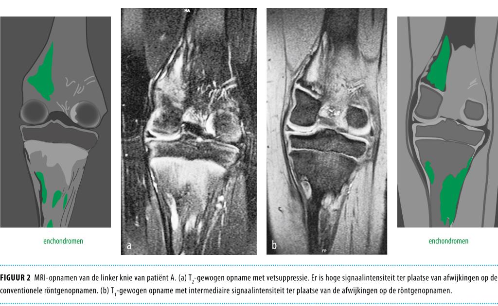 Progressief beenlengteverschil door multipele enchondromatose | NTVG