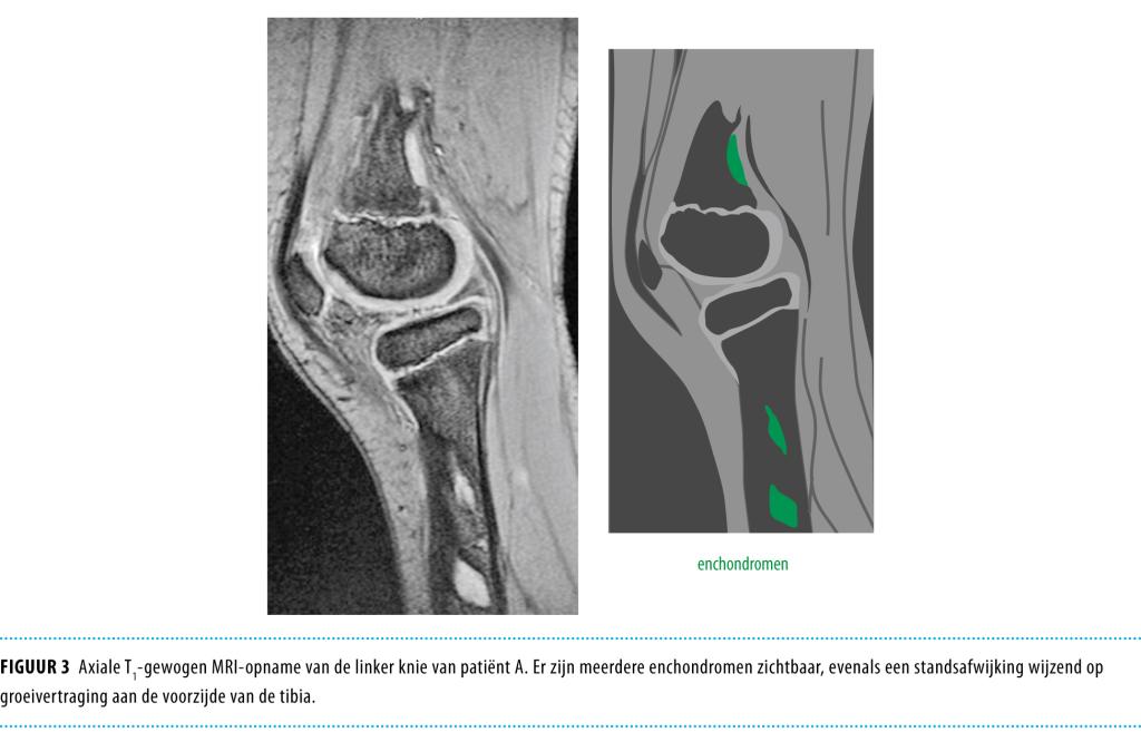 Progressief beenlengteverschil door multipele enchondromatose | NTVG