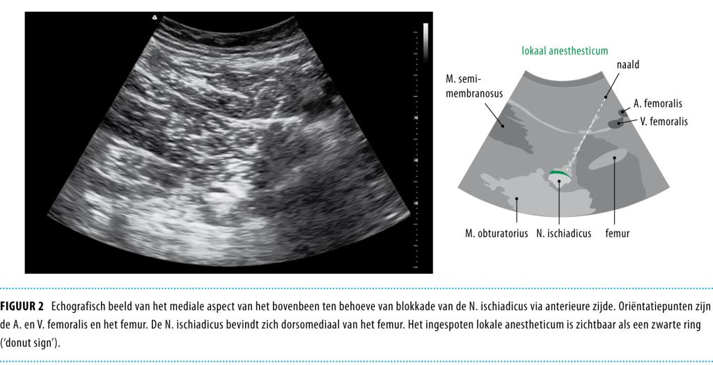 Blokkade van de N. ischiadicus via echogeleide anterieure benadering | NTVG