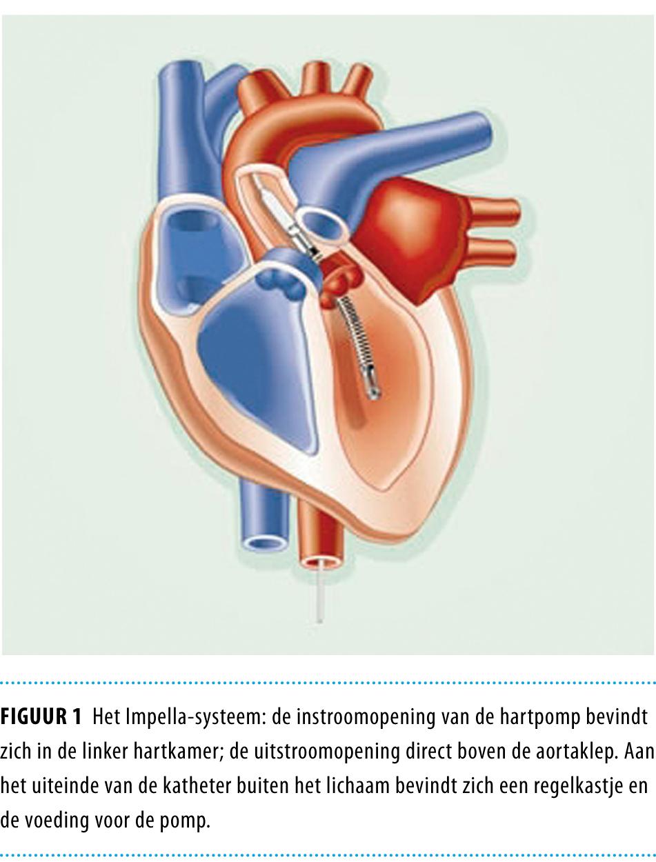 Het beschadigde hart: ondersteuning en herstel met het Impella-systeem ...