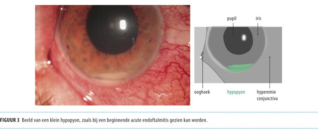 Infectieuze endoftalmitis na cataractextractie | NTvG