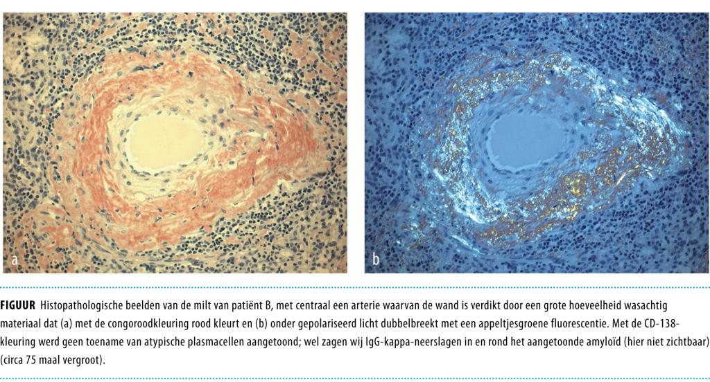 Miltruptuur zonder trauma | NTvG