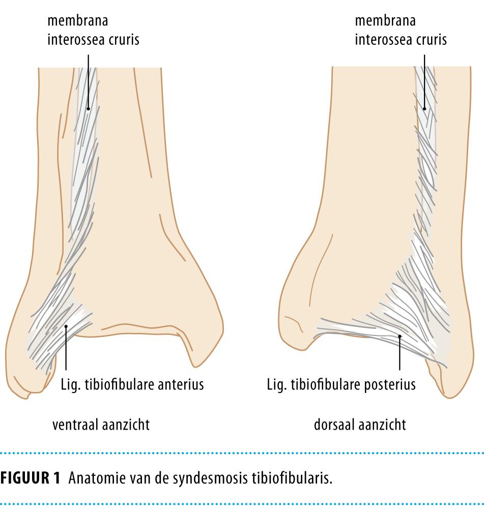 Ossificatie van de syndesmose na enkeltrauma | NTvG