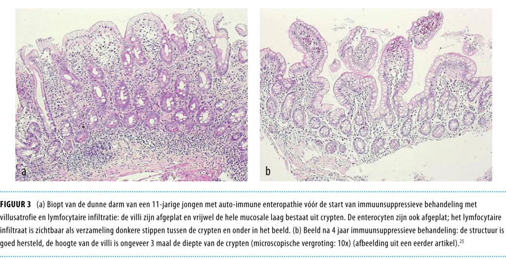 Auto-immune enteropathie bij kinderen | NTVG