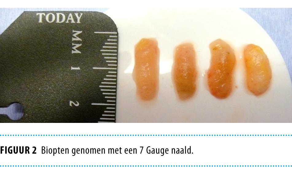 Fibroadenomen verwijderen met vacuümbiopsie | NTvG