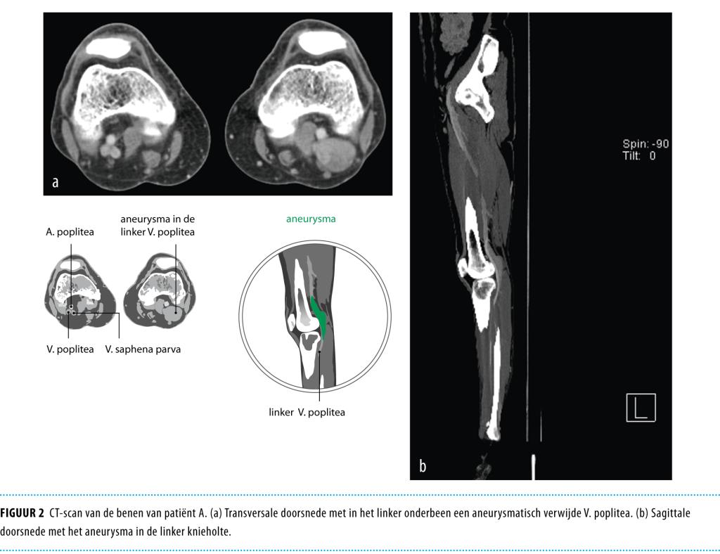 Aneurysmata van de V. poplitea: tijdig behandelen | NTvG