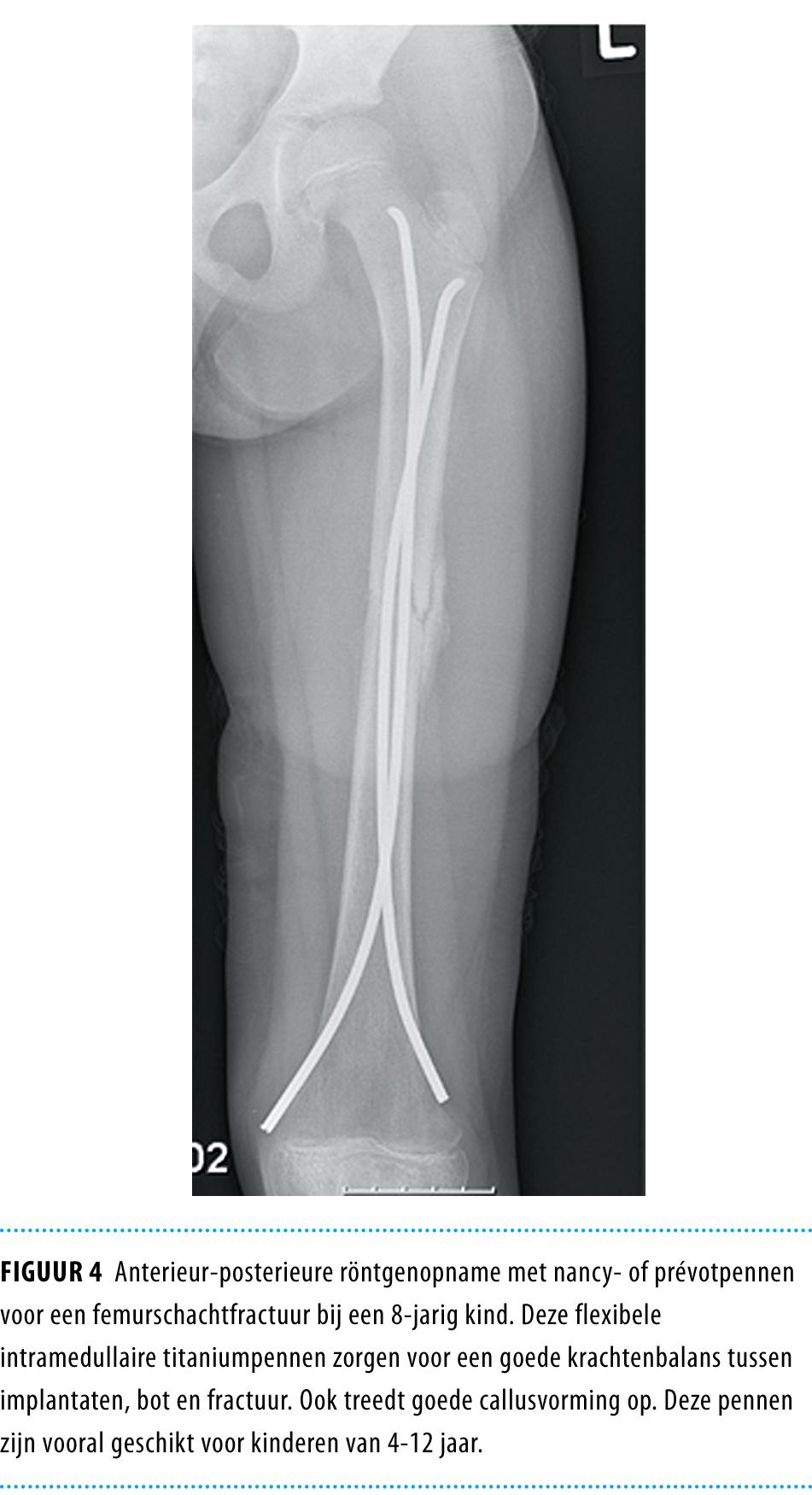 Leeftijdspecifieke behandeling van femurschachtfracturen bij kinderen ...