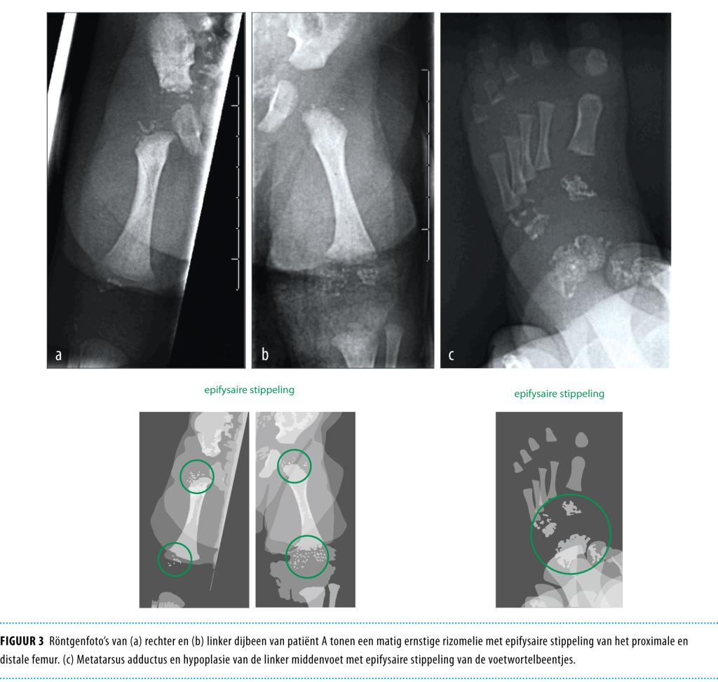 Het syndroom van Conradi-Hünermann-Happle | NTvG