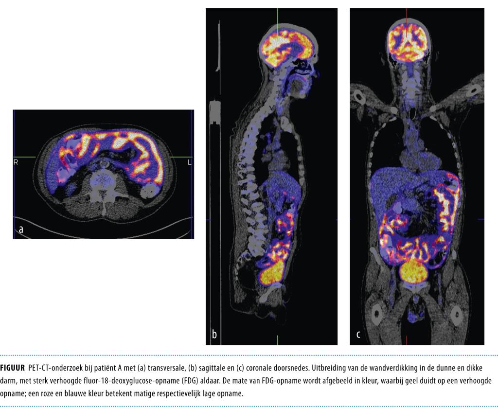 ‘Maligne peritoneaal mesothelioom’ | NTvG