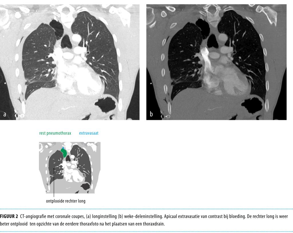 Embolisatie bij een spontane hematopneumothorax | NTvG