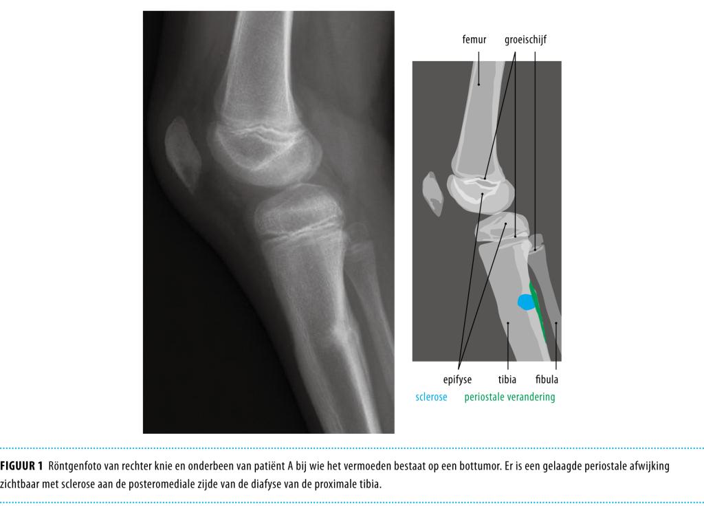 Een jongen met een pijnlijke knie | NTvG