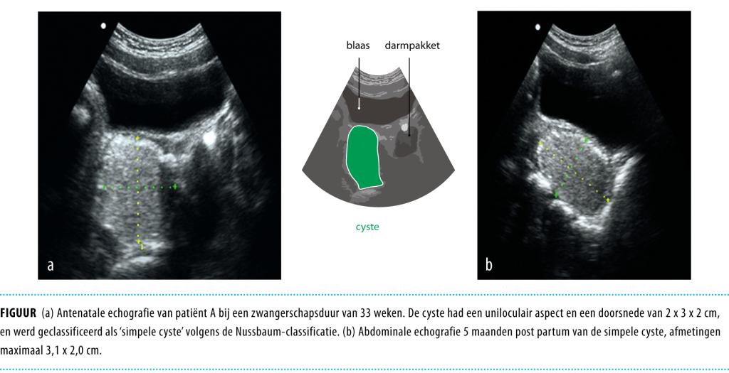 Een pasgeborene met een ovariumcyste | NTvG