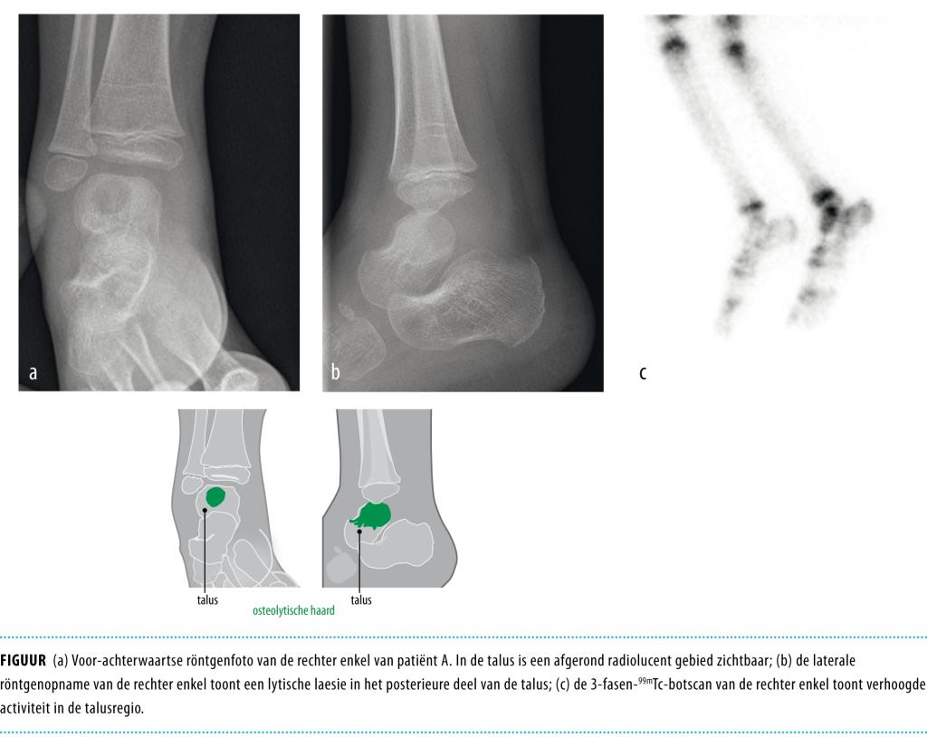 Osteomyelitis van de talus bij een mank lopend kind | NTvG
