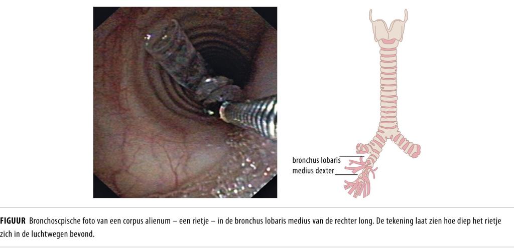 Een corpus alienum in de luchtwegen | NTVG