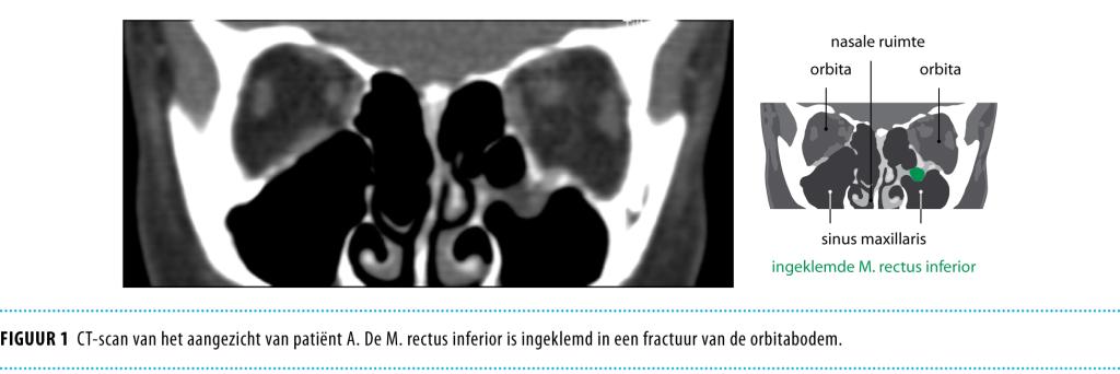 Oogtrauma bij kinderen | NTvG