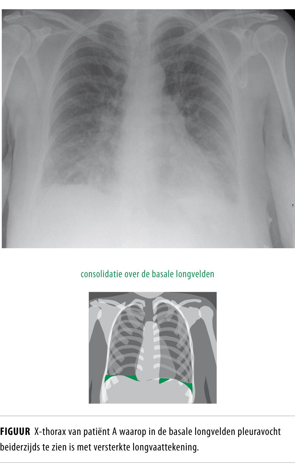 Maternaal longoedeem bij gebruik van atosiban bij meerlingzwangerschap ...