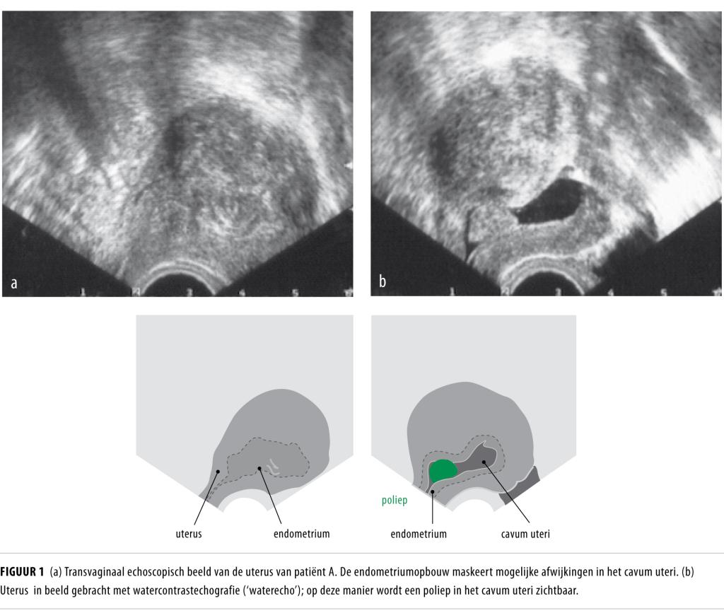 Polikliniek voor abnormaal uterien bloedverlies | NTvG