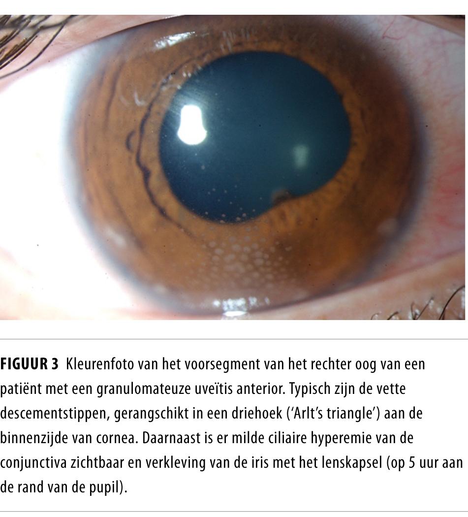 Diagnose en behandeling van uveїtis | NTVG