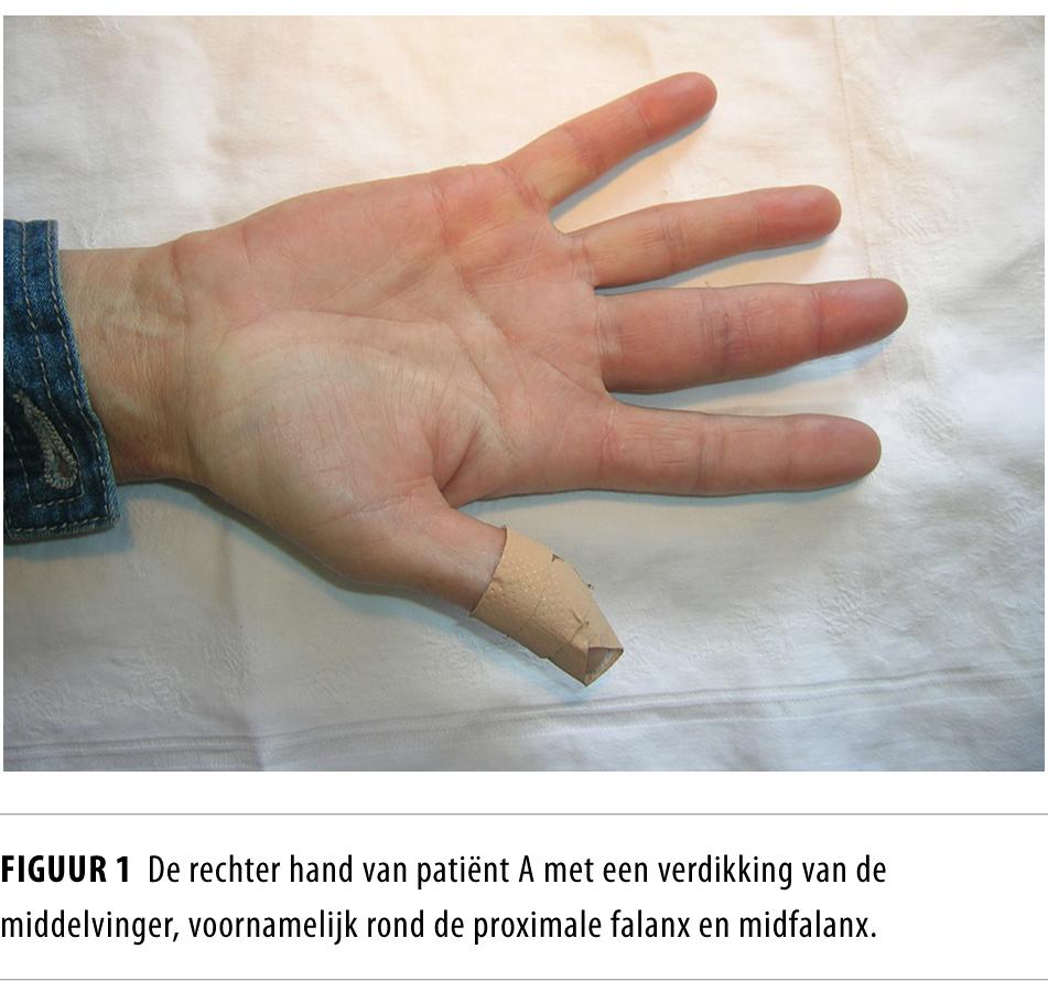 Zwelling van de vinger als eerste teken van sarcoïdose | NTVG