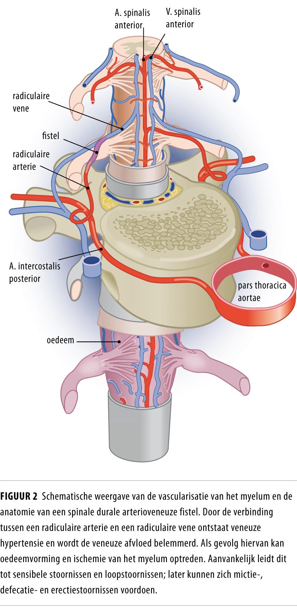Spinale durale arterioveneuze fistel | NTVG