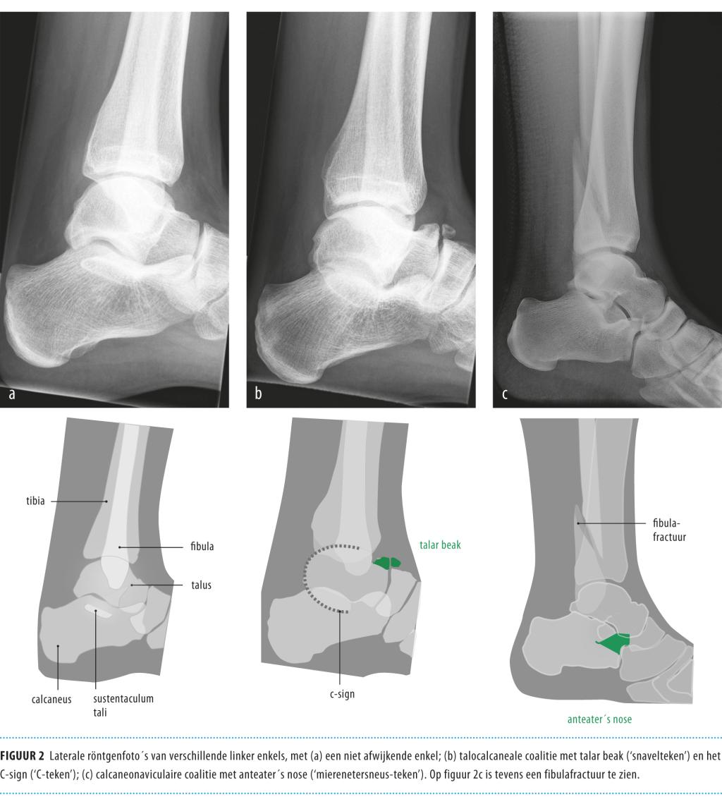 Herkenning van een tarsale coalitie | NTvG
