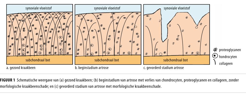 Meting van kraakbeenkwaliteit met behulp van MRI | NTvG