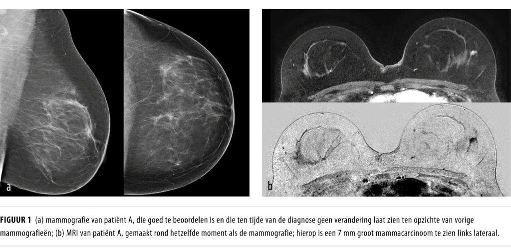 Keuzes bij erfelijk risico op borstkanker | NTvG
