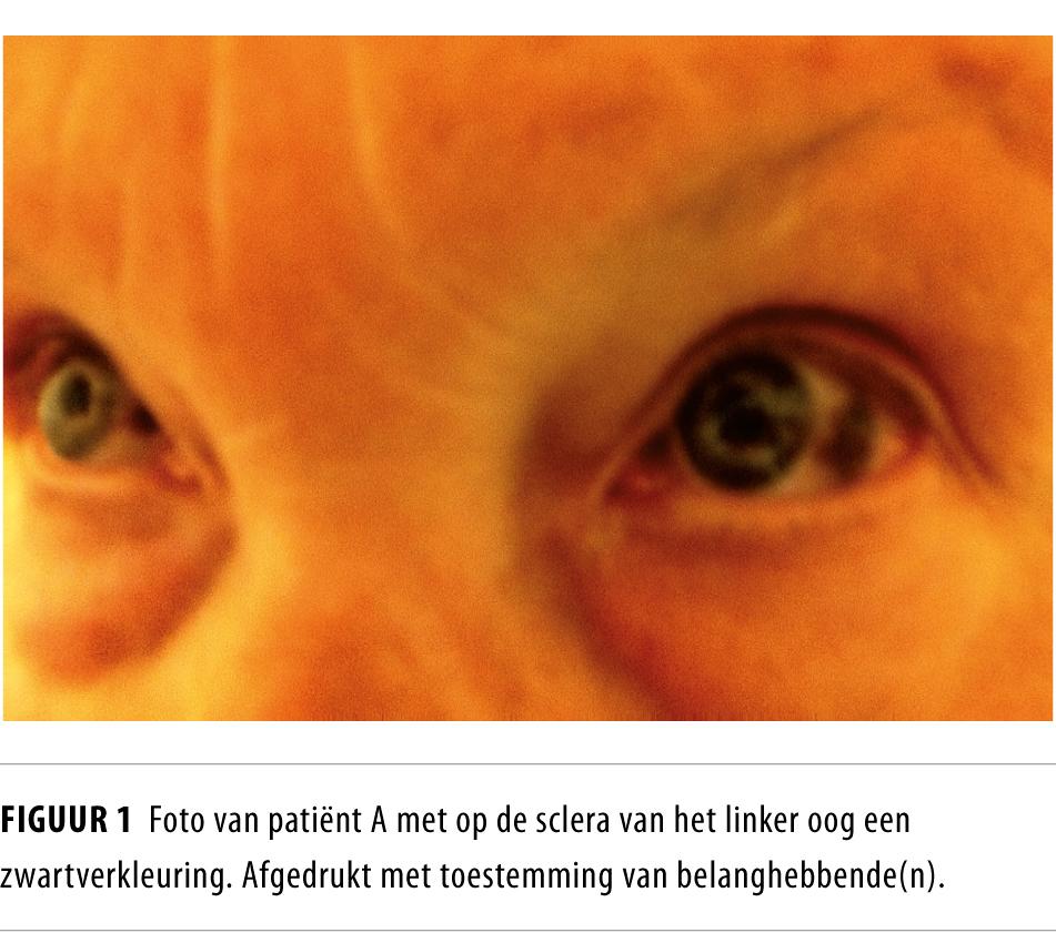 Zwarte urine of zwart oogwit? Denk aan alkaptonurie | NTVG