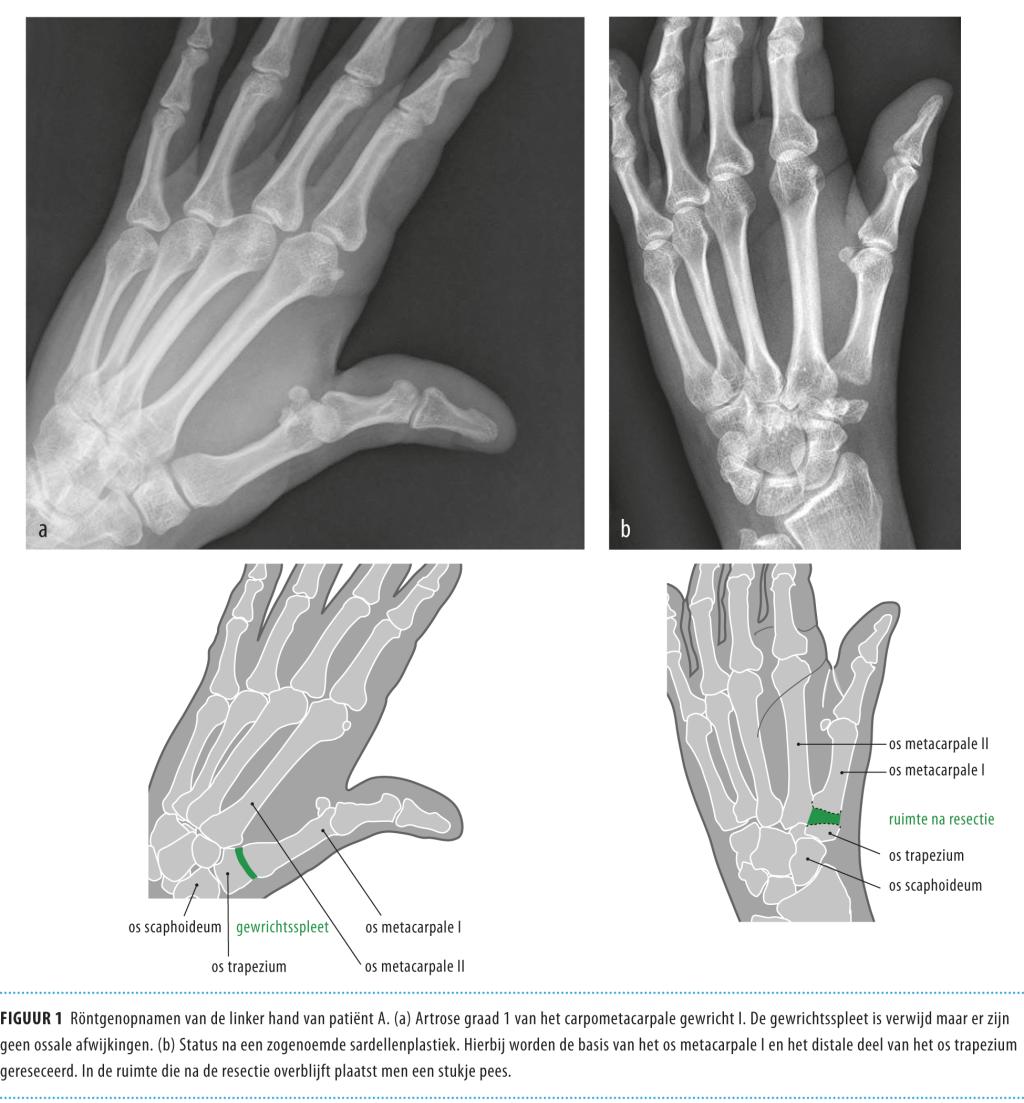 Behandeling van artrose van de duimbasis | NTVG