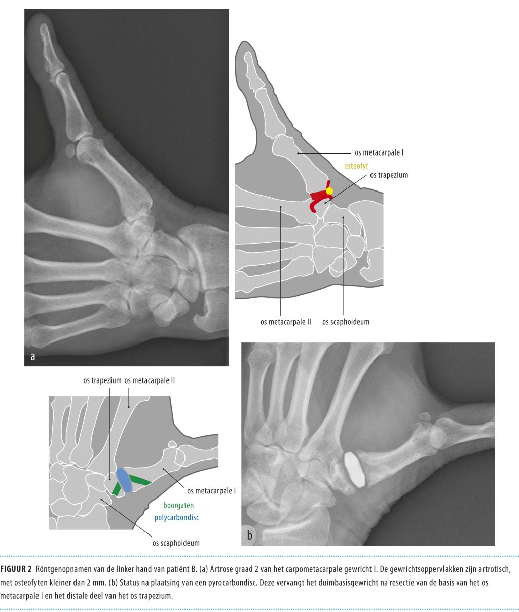 Behandeling van artrose van de duimbasis | NTVG