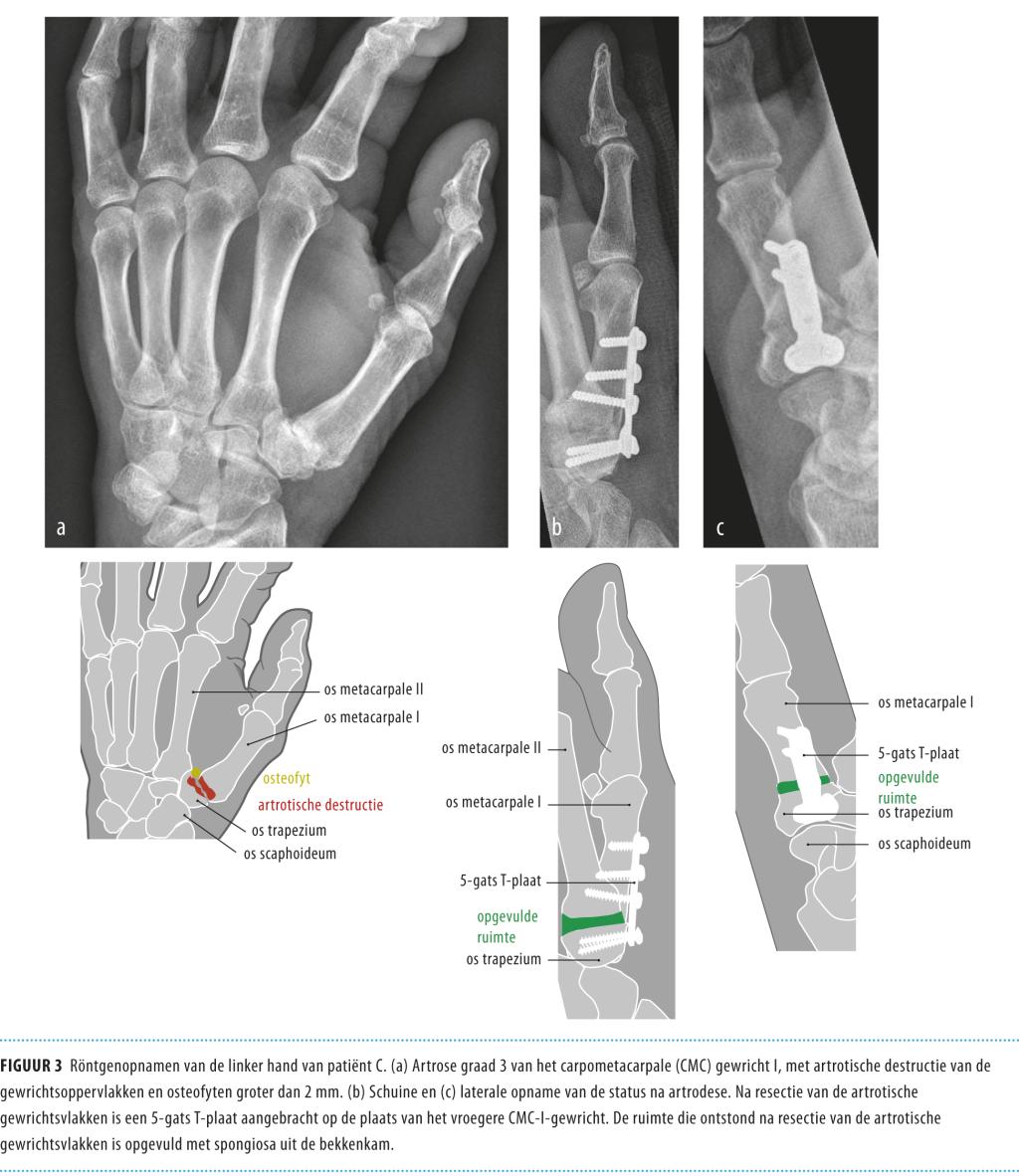Behandeling van artrose van de duimbasis | NTVG